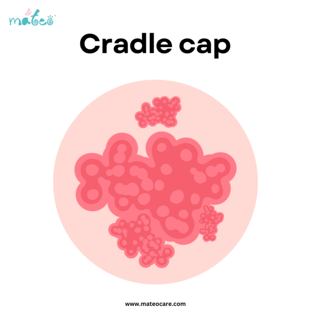 Serious Skin Conditions in Babies - Mateocare